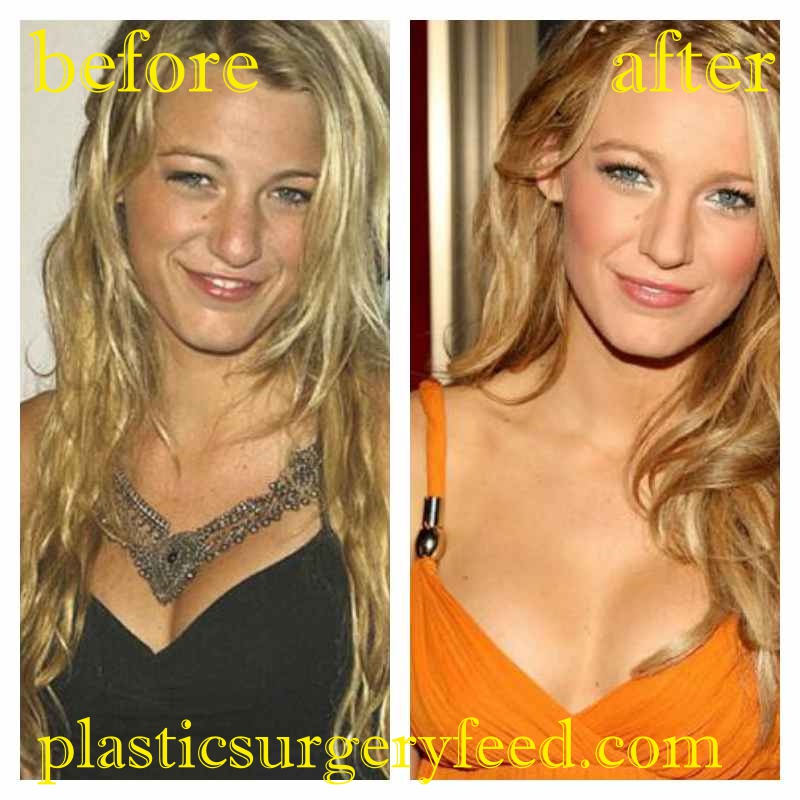 Blake Lively Breast Augmentation - Plastic Surgery Feed Blake Lively Breast Augmentation - Plastic Surgery Feed